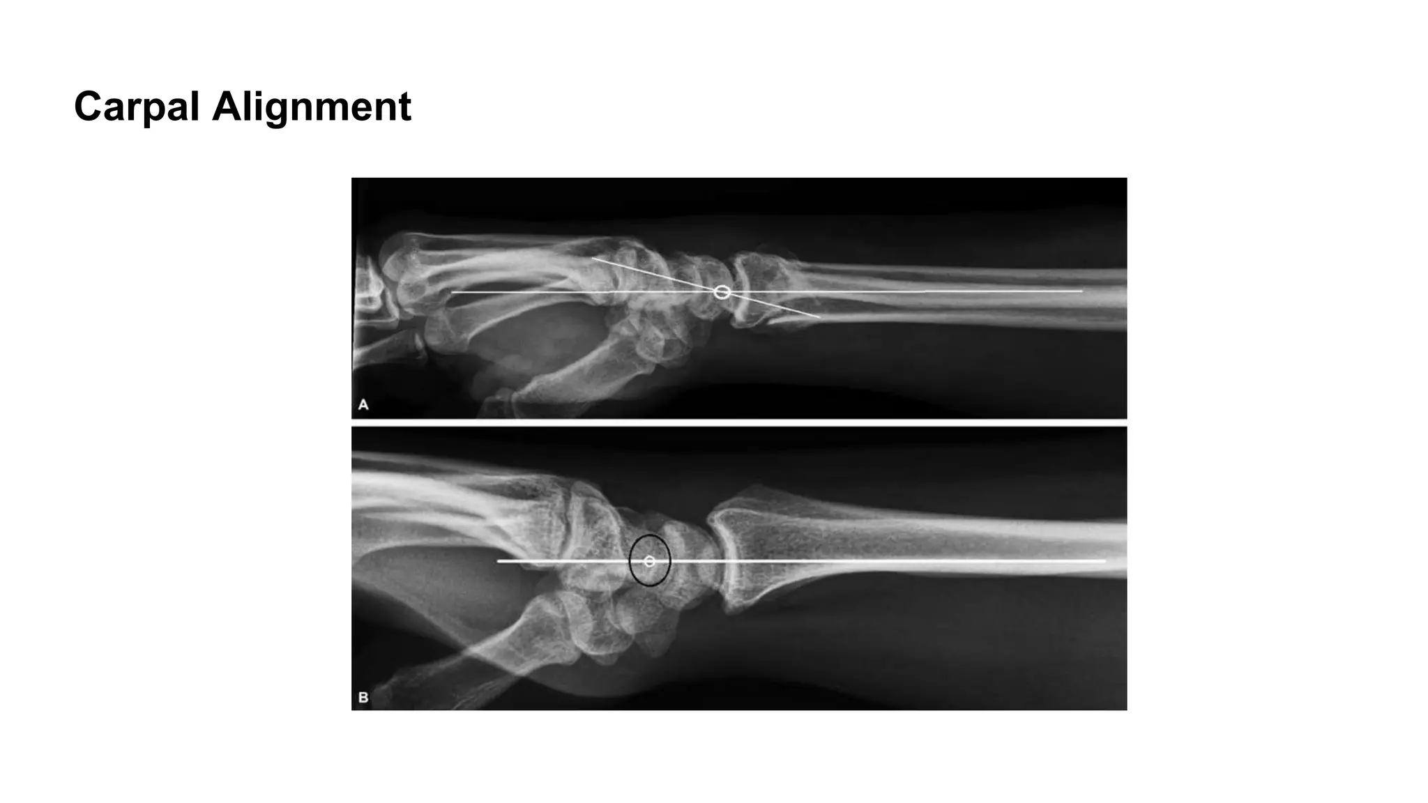 Distal radius fracture | PPTX