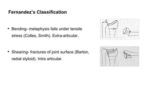 Distal radius fracture | PPTX