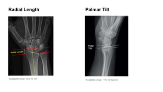 Distal radius fracture | PPTX