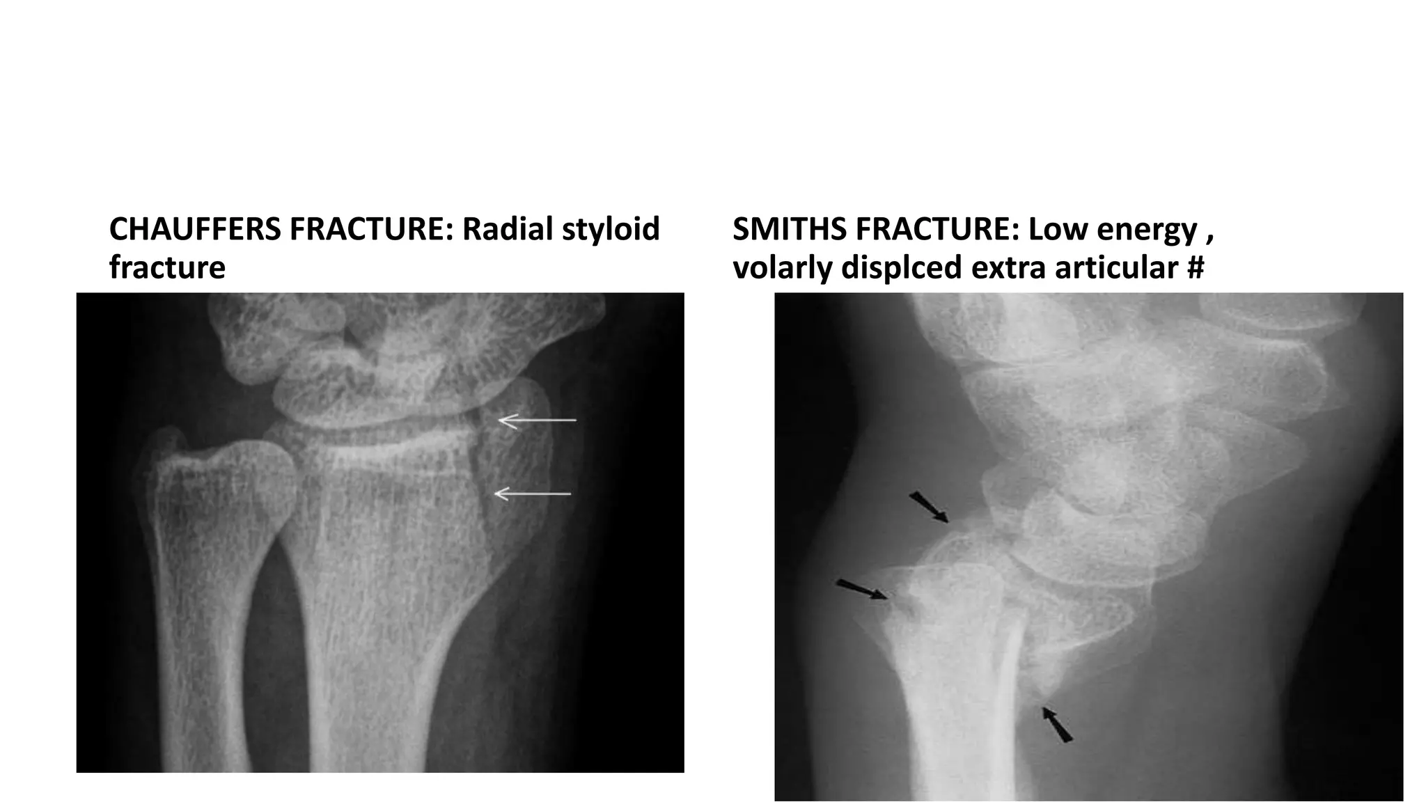 Distal radius fracture in adults | PPTX