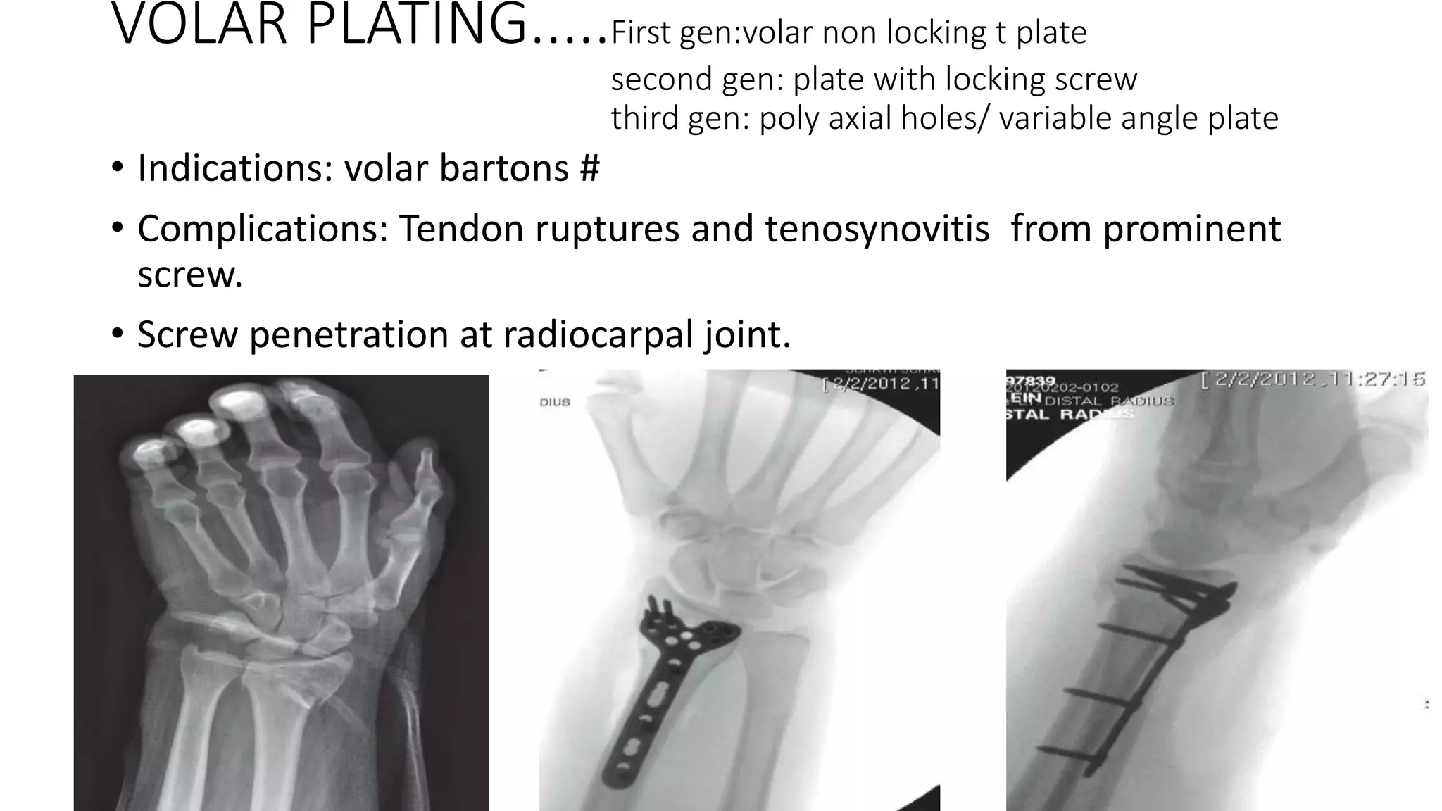 Distal radius fracture in adults | PPTX