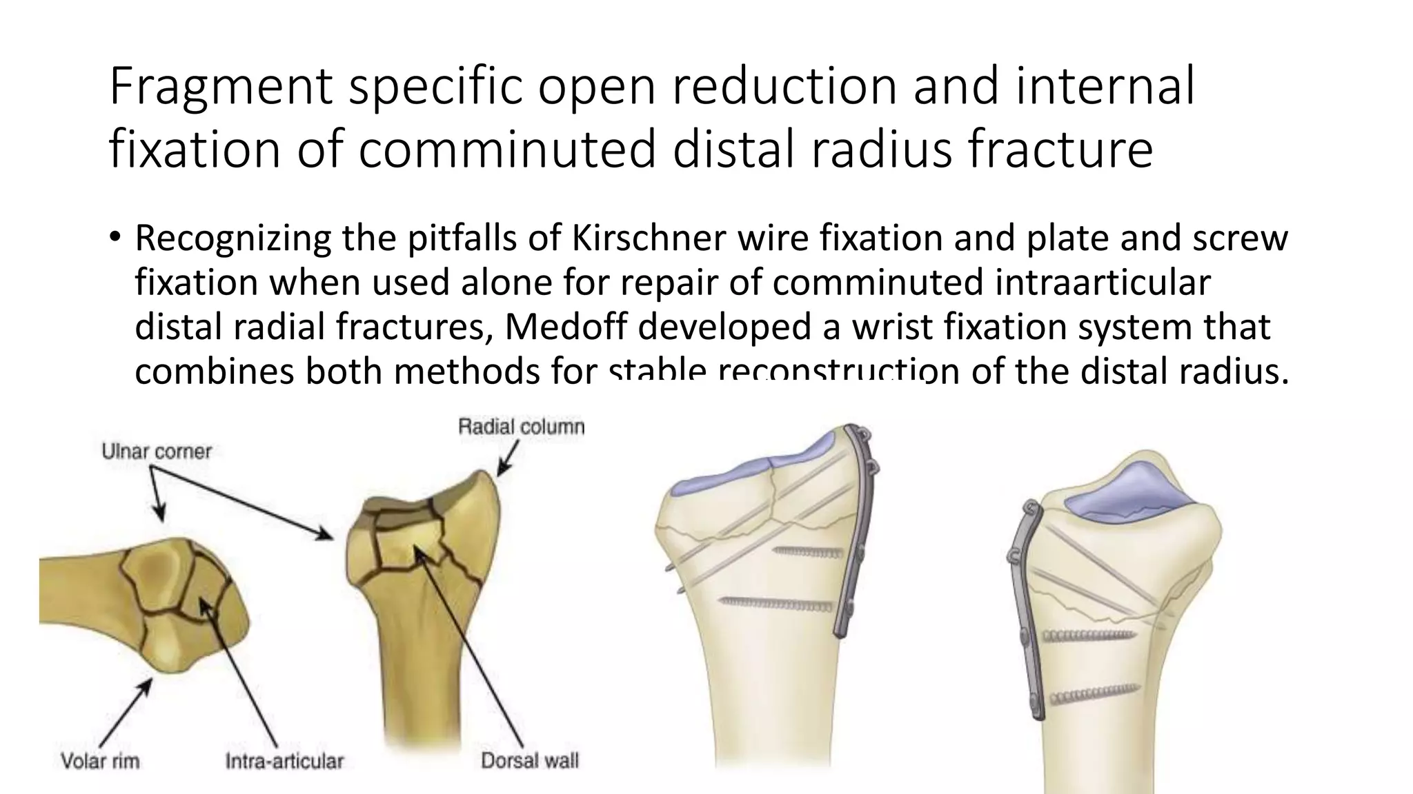 Distal radius fracture in adults | PPTX | First Aid | Injuries