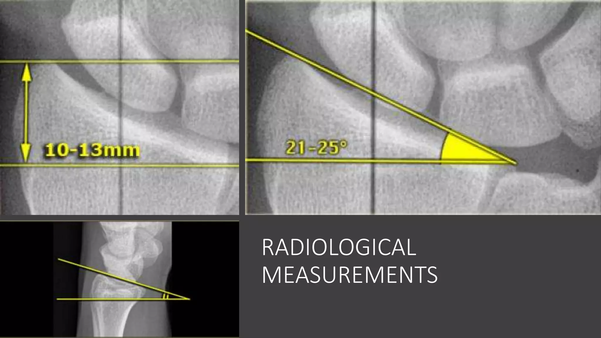 Distal radius fracture in adults | PPTX