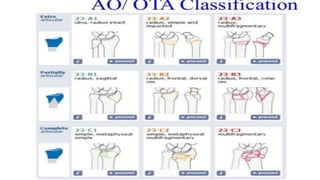 Distal radius fracture in adults | PPTX