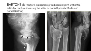 Distal radius fracture in adults | PPTX | First Aid | Injuries