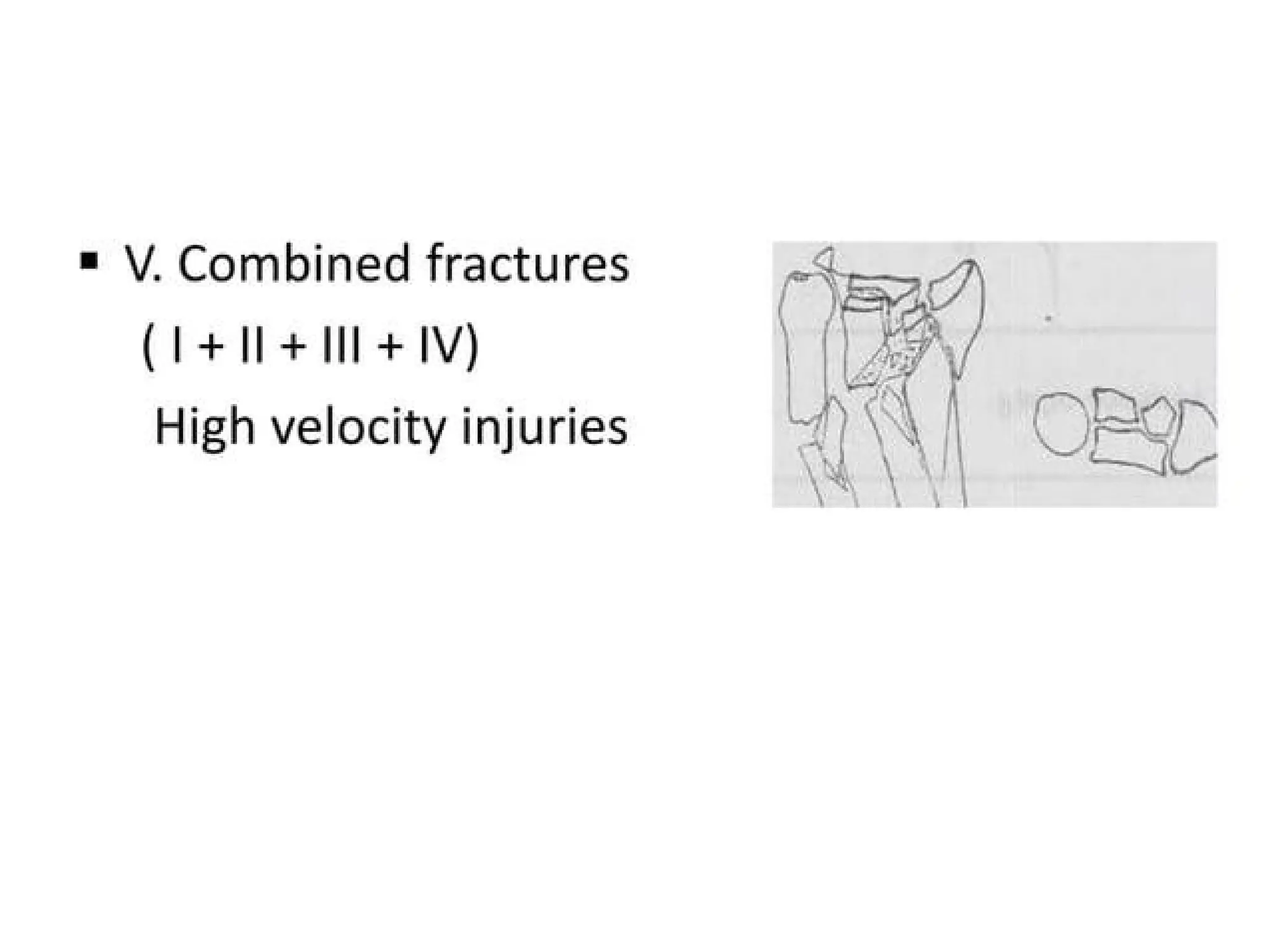 Distal Radius Fracture Case Presentation Pptx