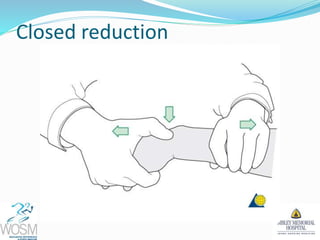 Distal Radius Fractures | PPTX