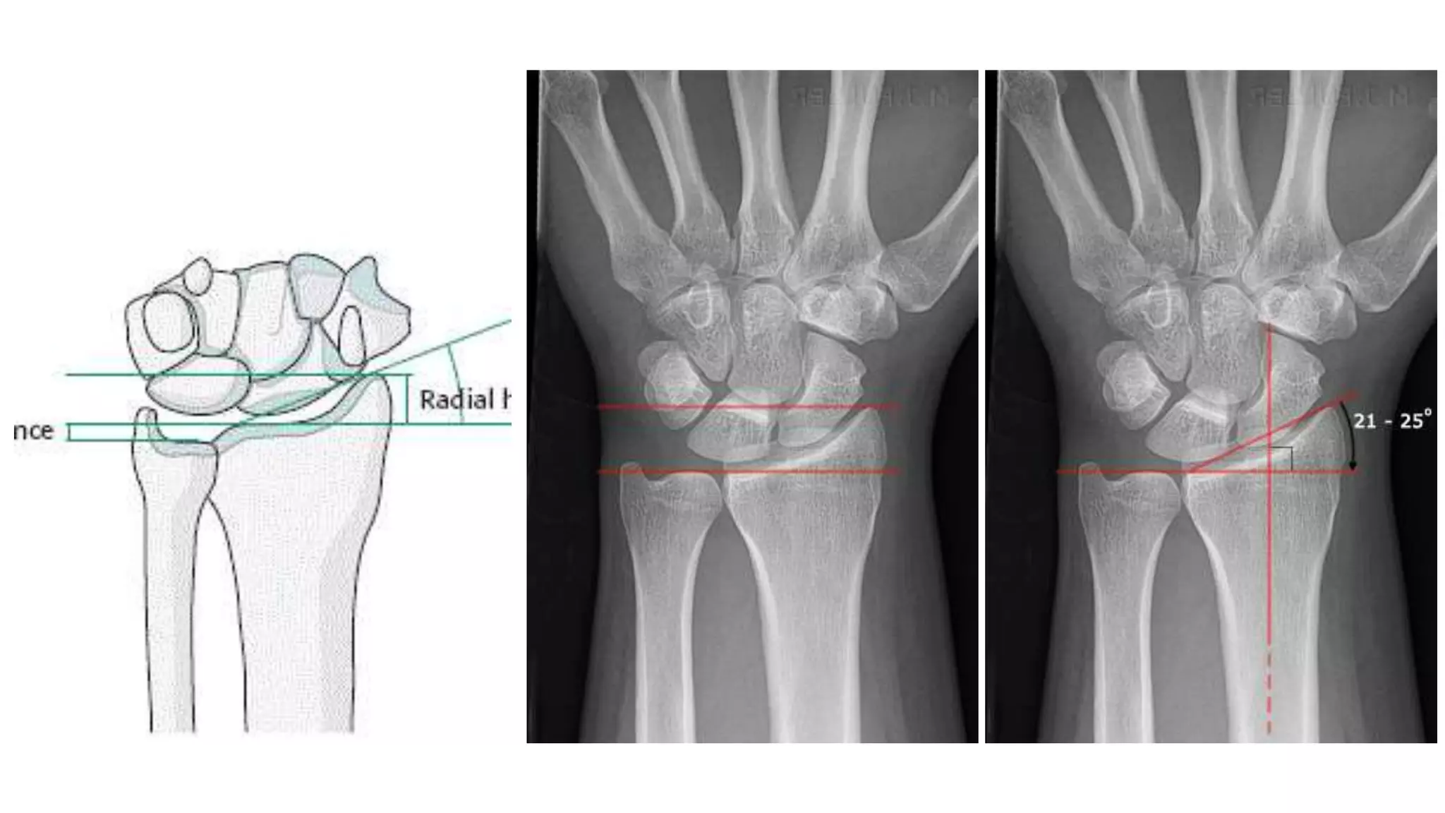 Distal radius fractures | PPTX