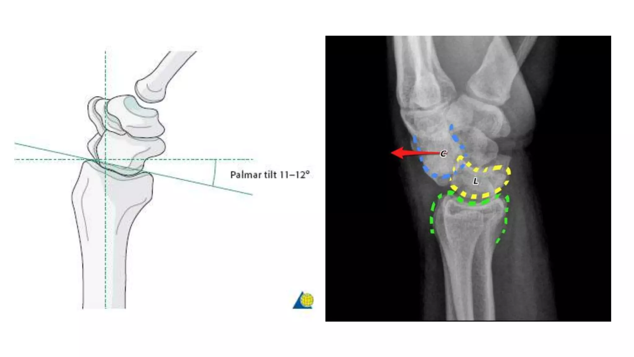 Distal radius fractures | PPTX