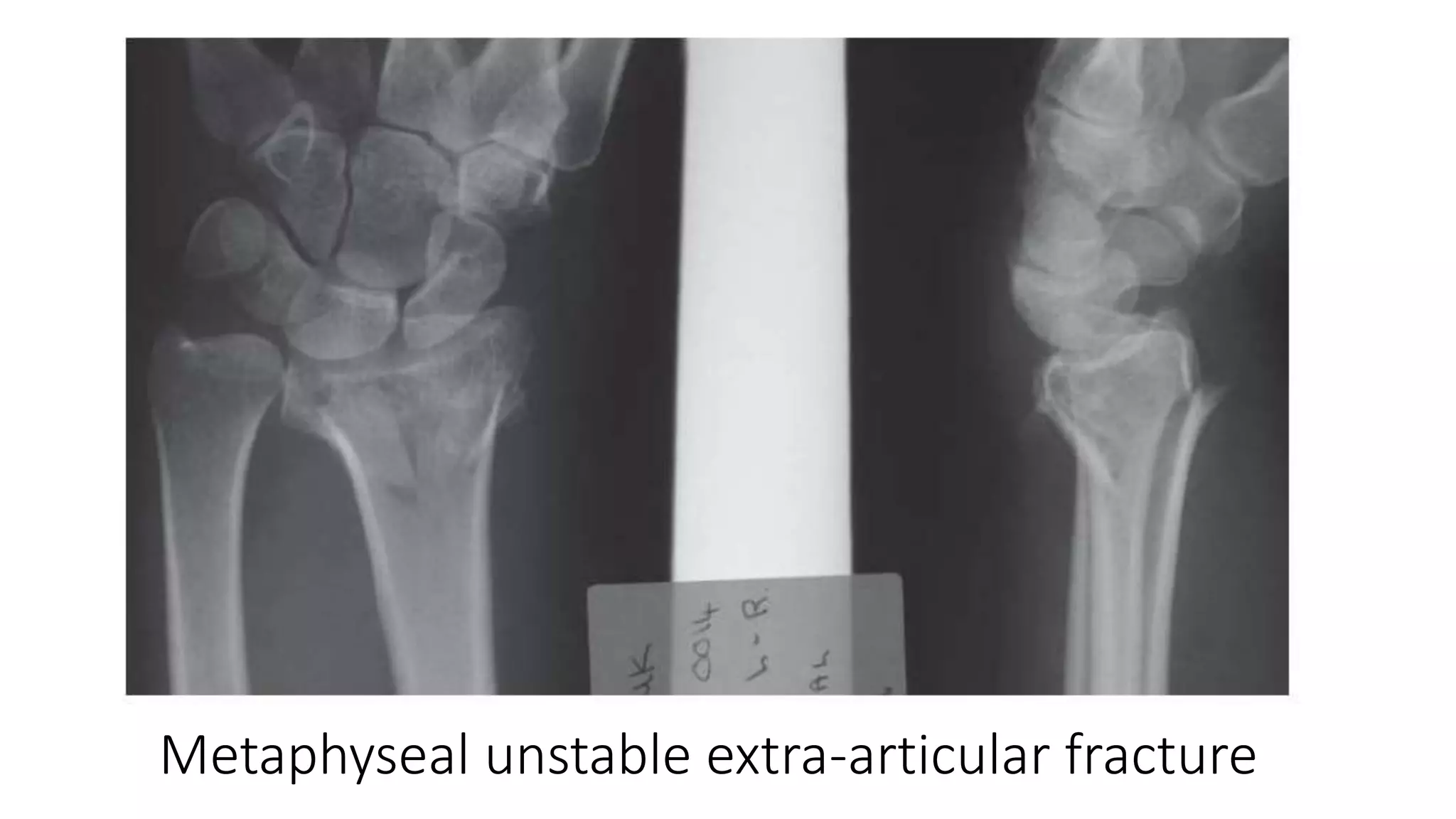 Distal radius fractures | PPTX