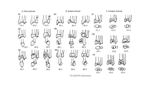 Distal radius fractures | PPTX