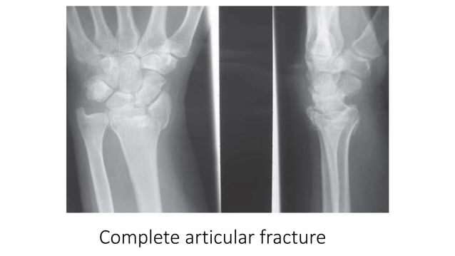 Distal radius fractures | PPTX