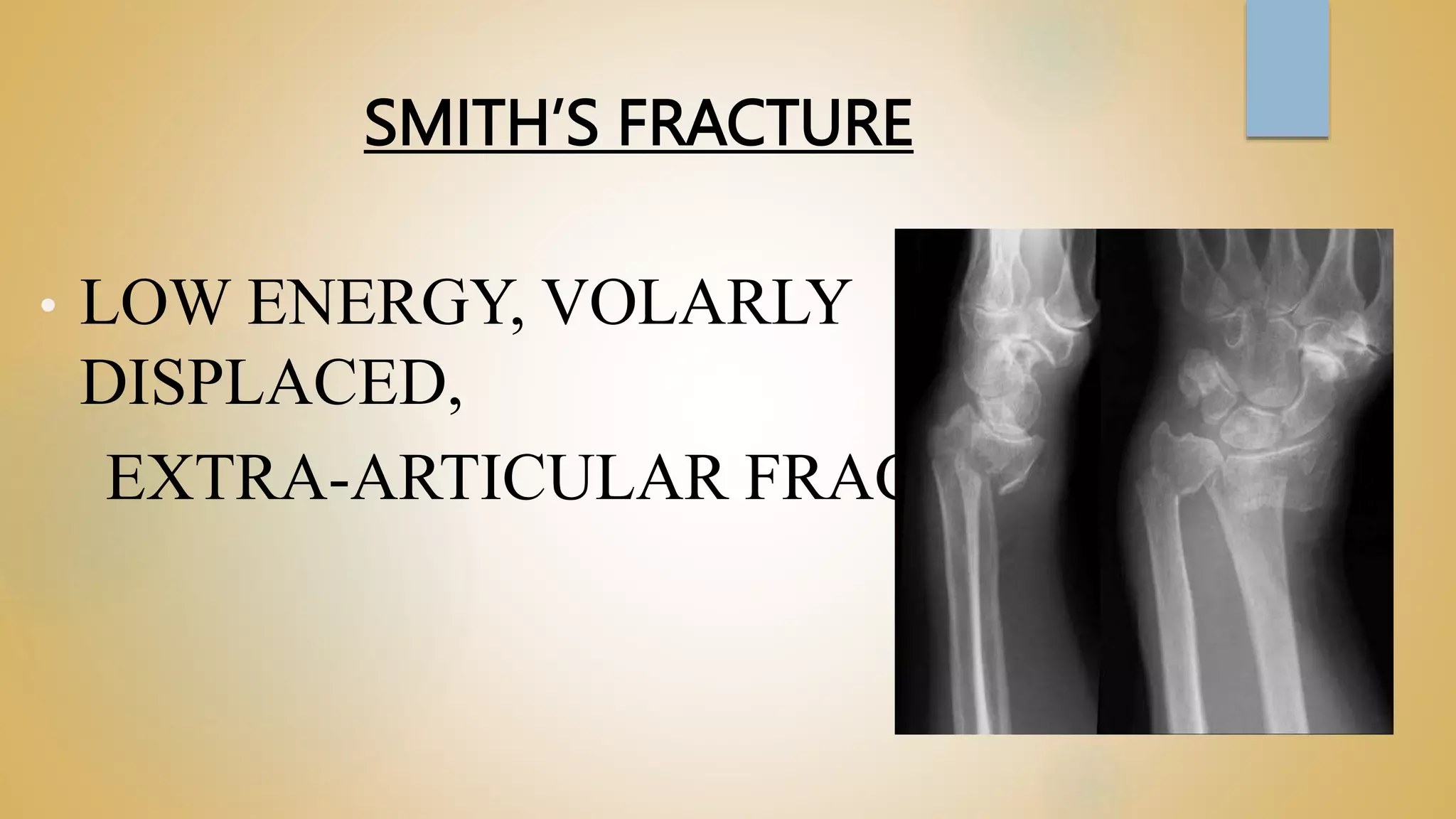 DISTAL RADIUS FRACTURES.pptx | Death, Injury, or Military Conflict ...