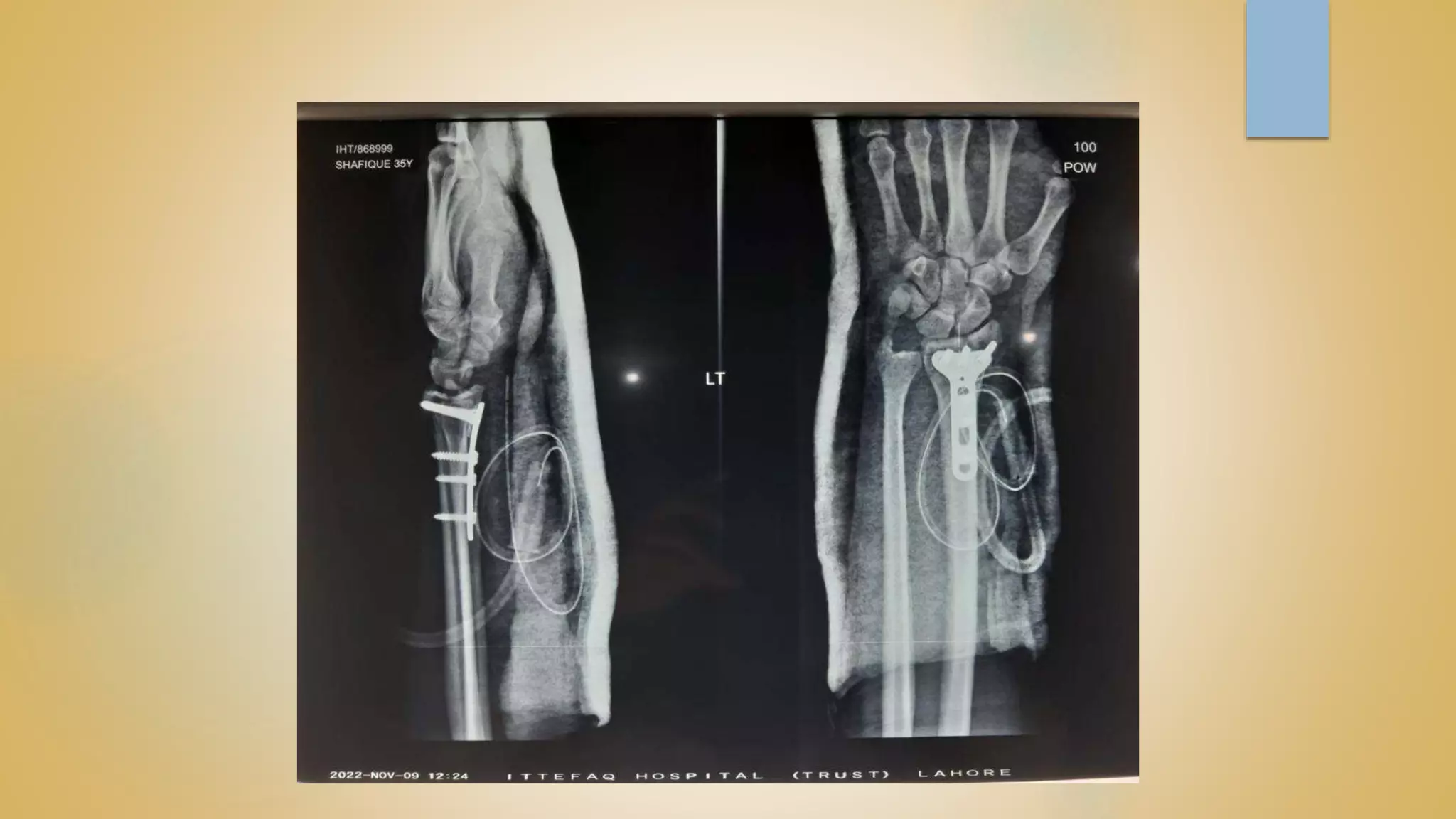 DISTAL RADIUS FRACTURES.pptx