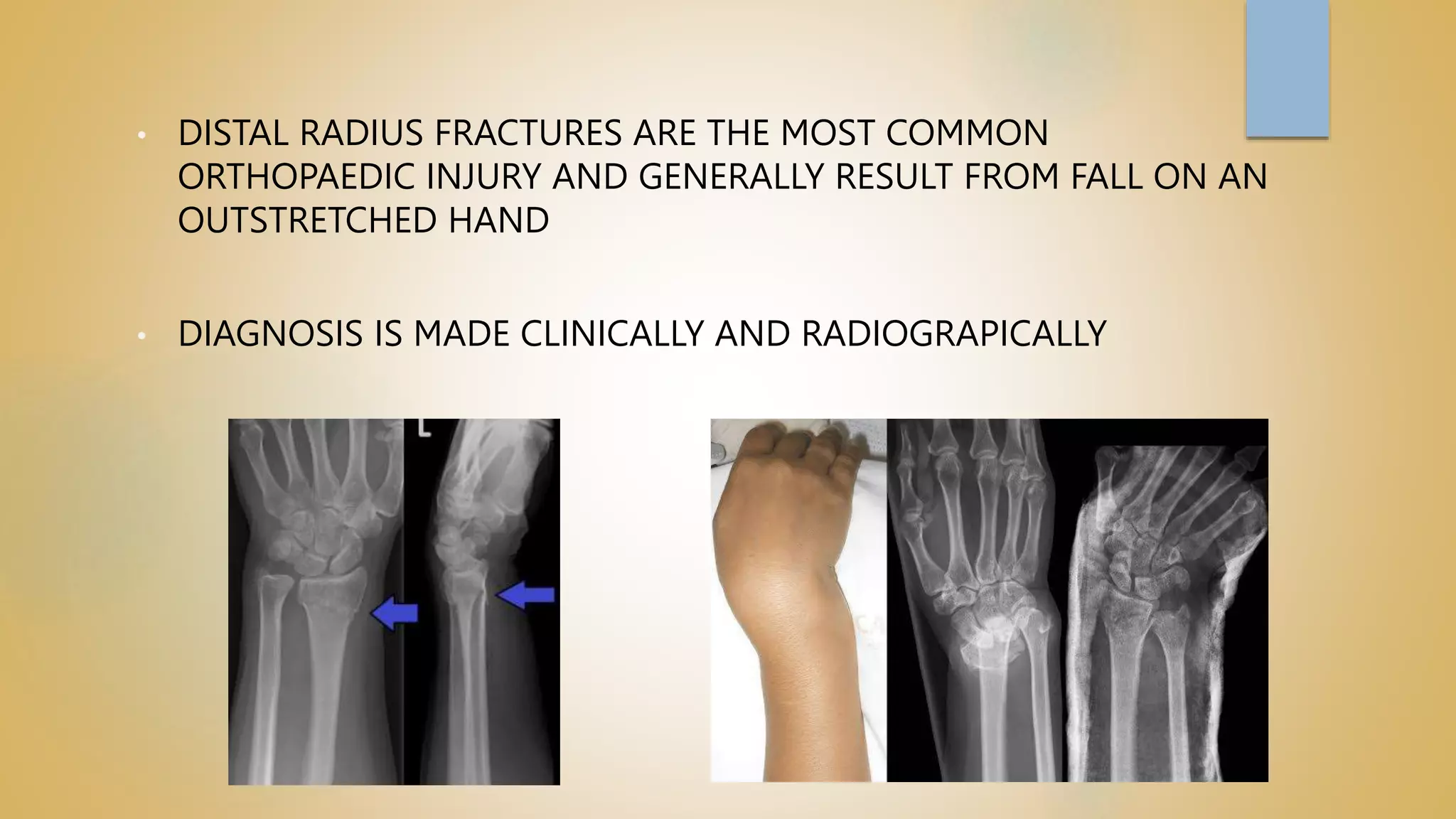 DISTAL RADIUS FRACTURES.pptx | Death, Injury, or Military Conflict ...