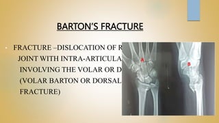 DISTAL RADIUS FRACTURES.pptx | Death, Injury, or Military Conflict ...