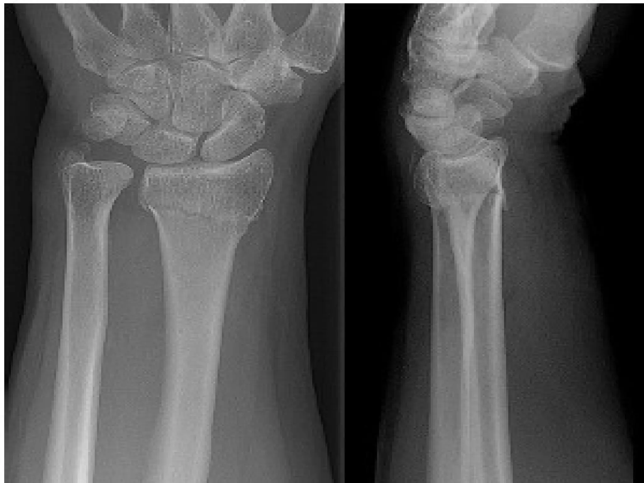 Distal Radius Fractures.pptx for bhms students | PPTX
