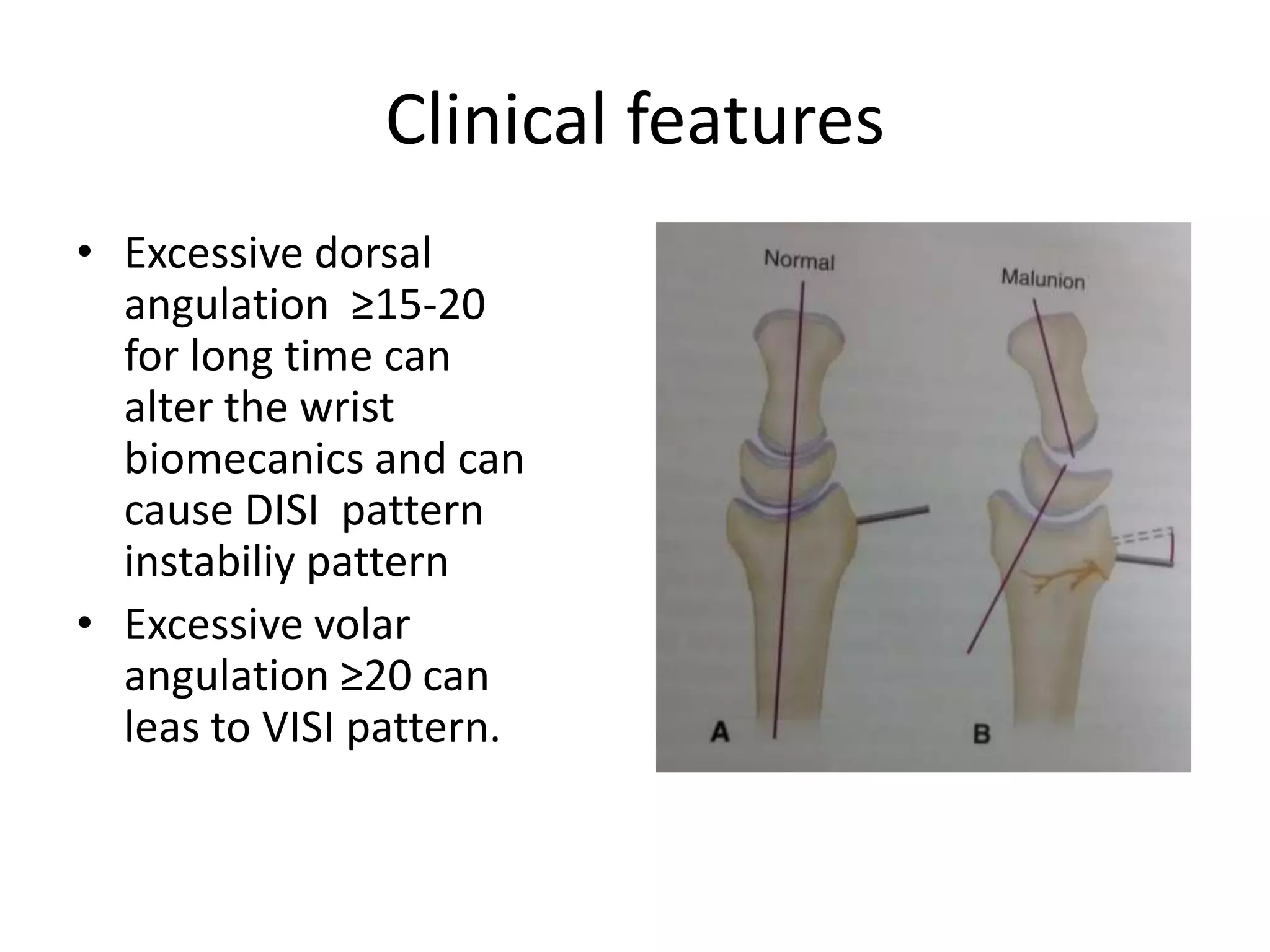 Distal radius malunion , correction | PPT