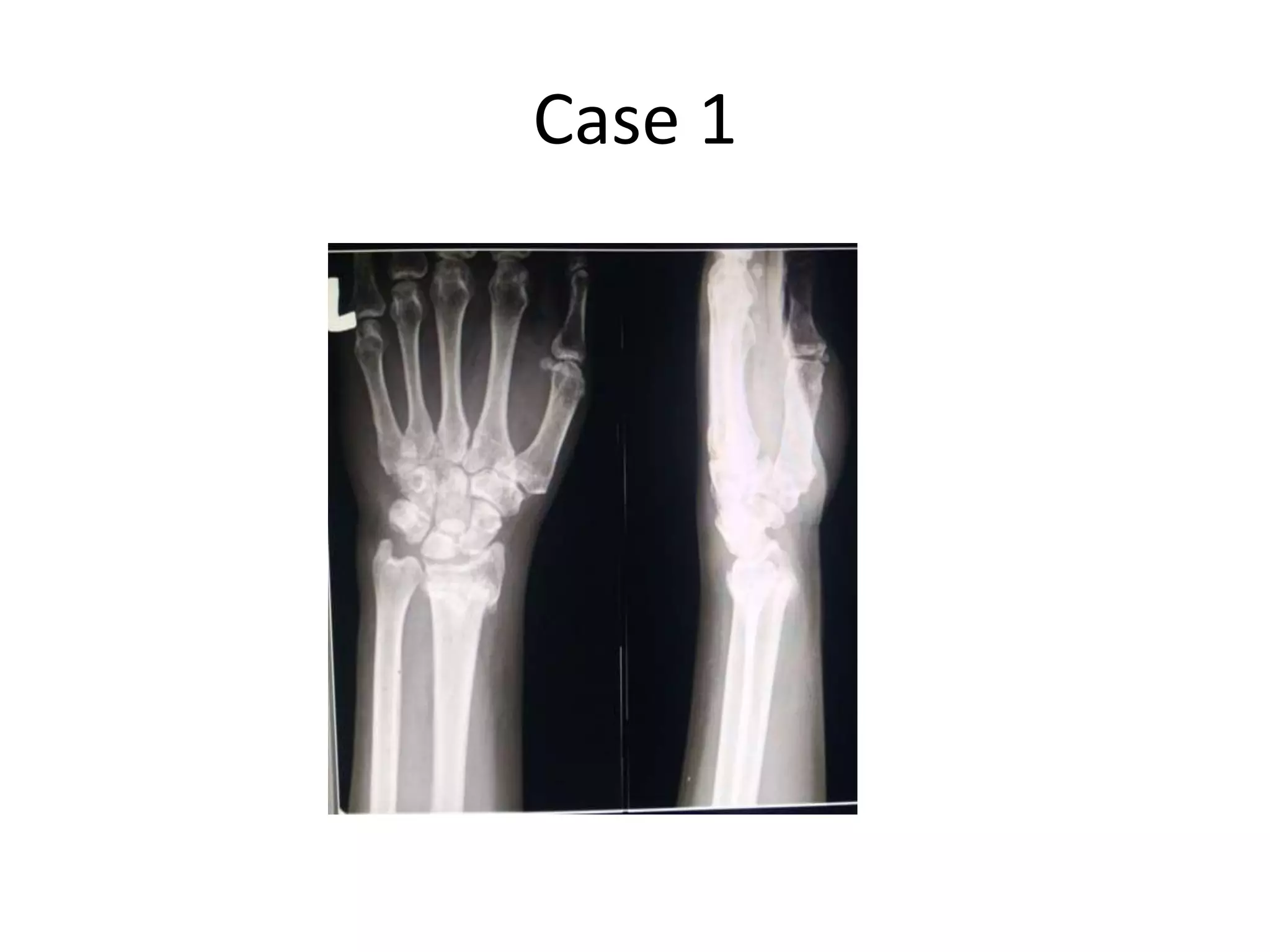 Distal radius malunion , correction | PPT