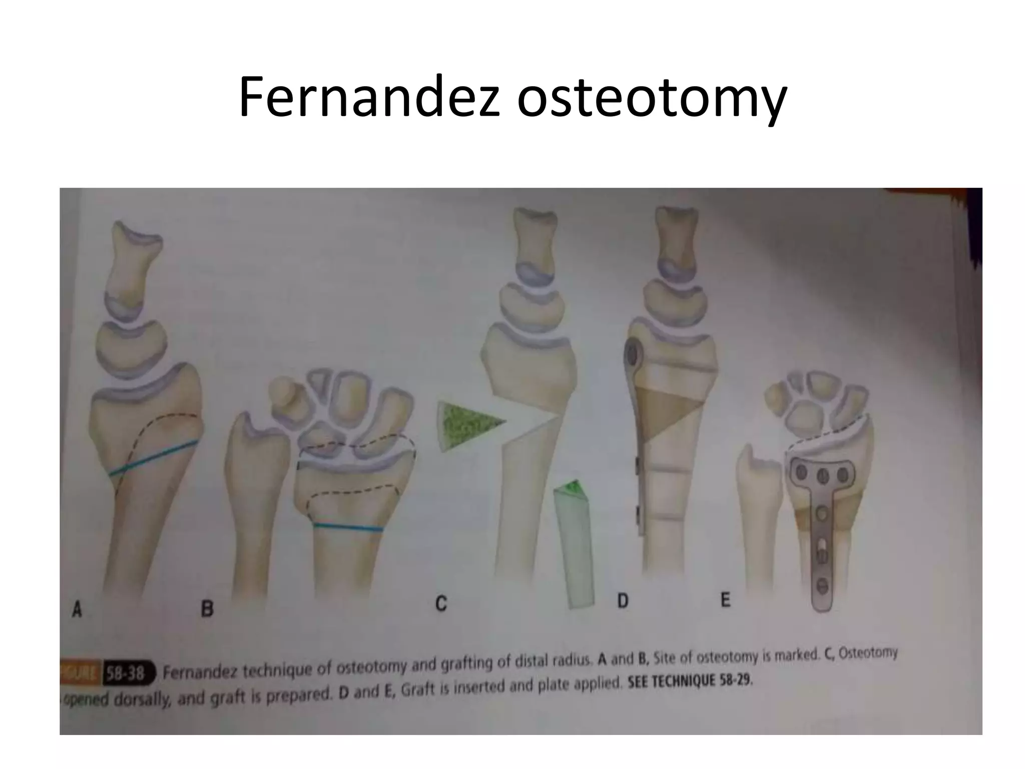 Distal radius malunion , correction | PPT