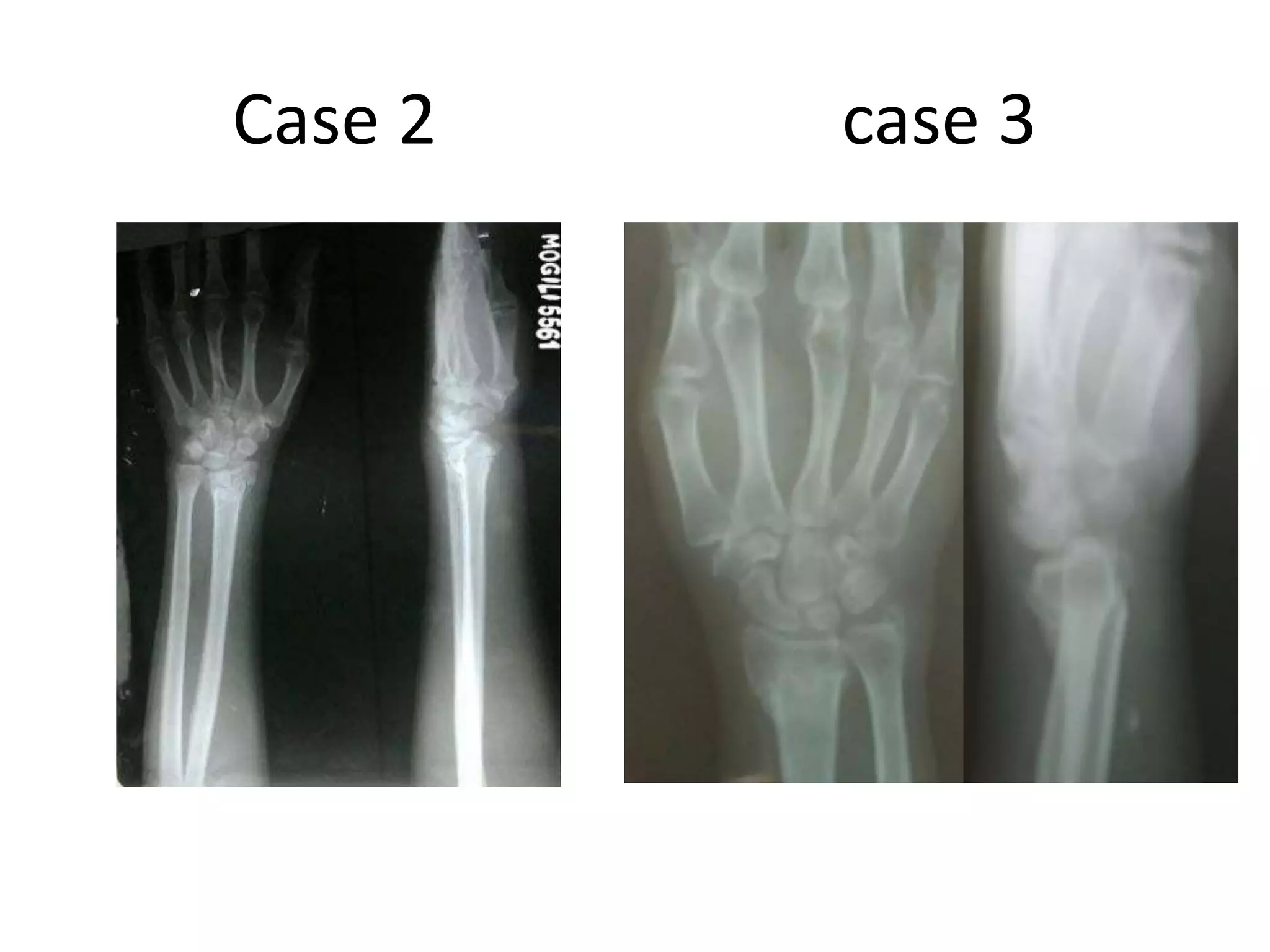 Distal radius malunion , correction | PPT