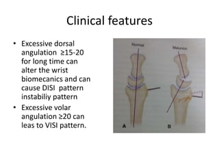 Distal radius malunion , correction | PPT
