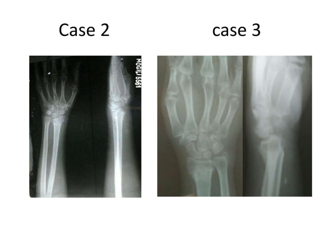 Distal radius malunion , correction | PPT