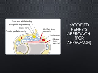 Distal Radius Fractures and treatment ad | PPT | Death, Injury, or ...