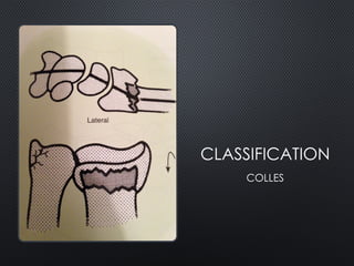 Distal Radius fractures, treatment, comp | PPT