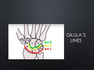 Distal Radius fractures, treatment, comp | PPT