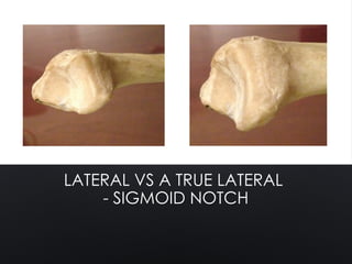 Distal Radius fractures, treatment, comp | PPT