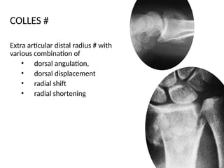 distal radius fractures power point.pptx