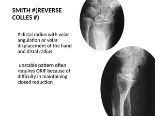 distal radius fractures power point.pptx