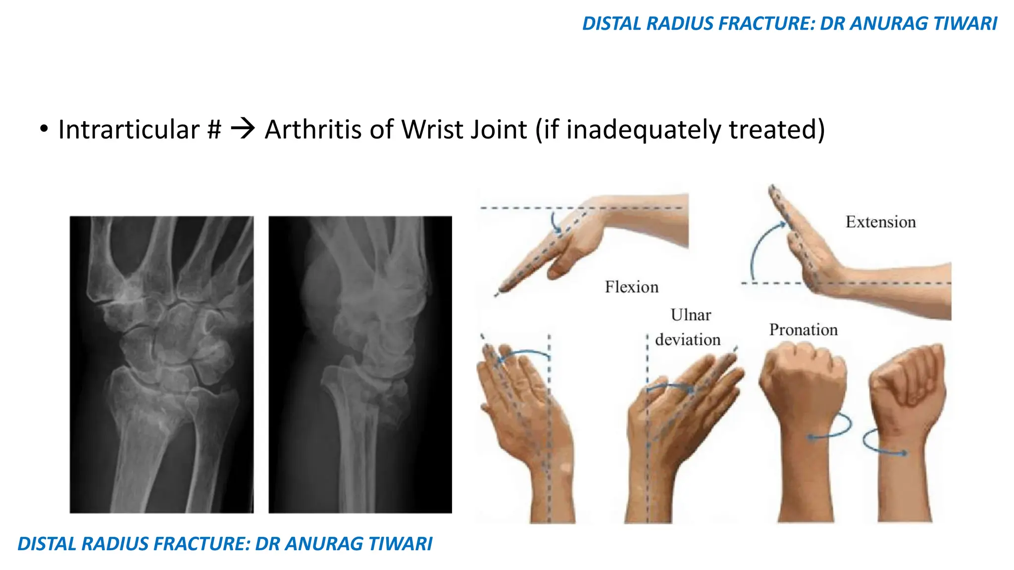 Distal radius #UG .pptx