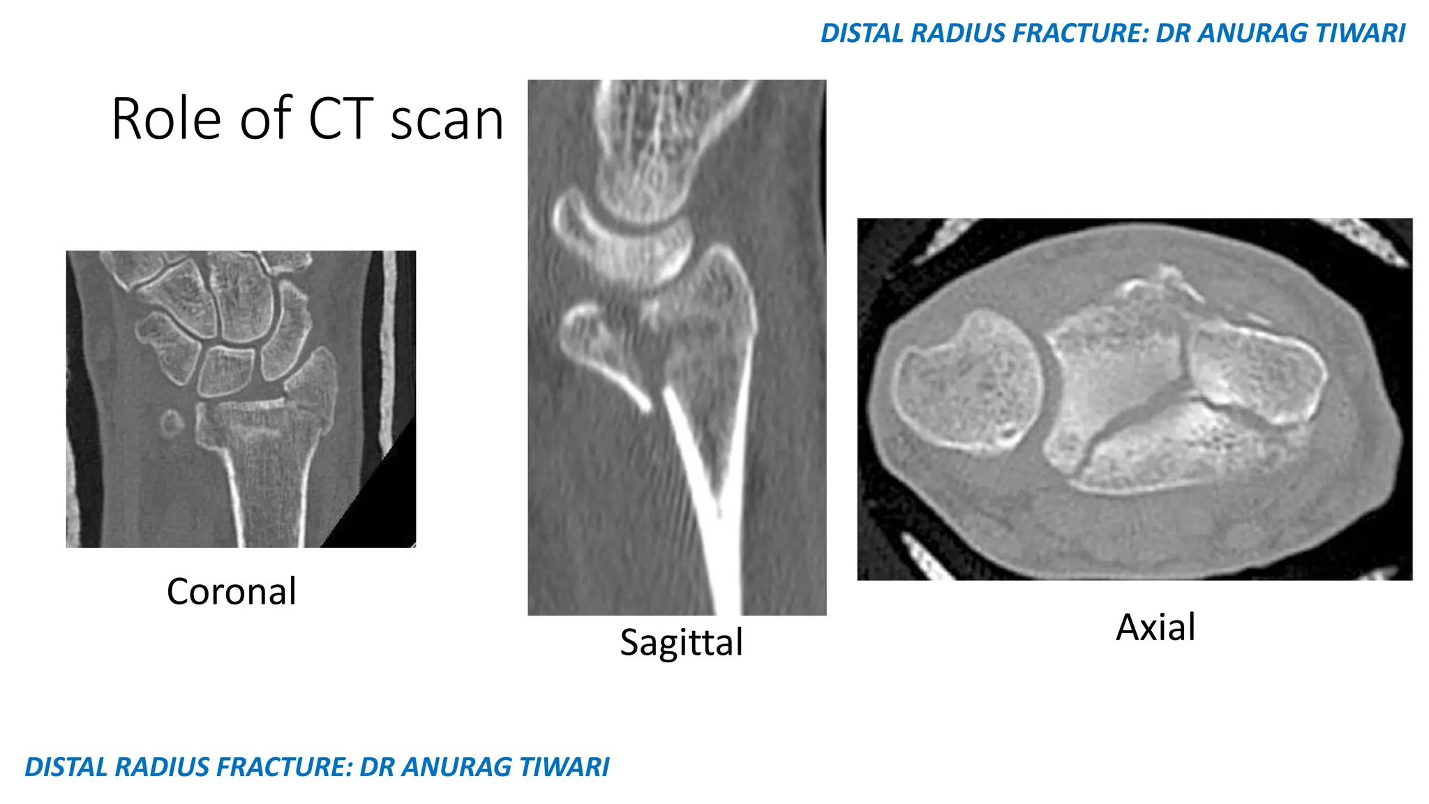 Distal radius #UG .pptx