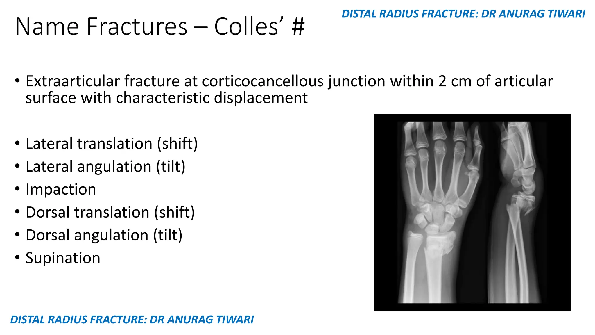 Distal radius #UG .pptx