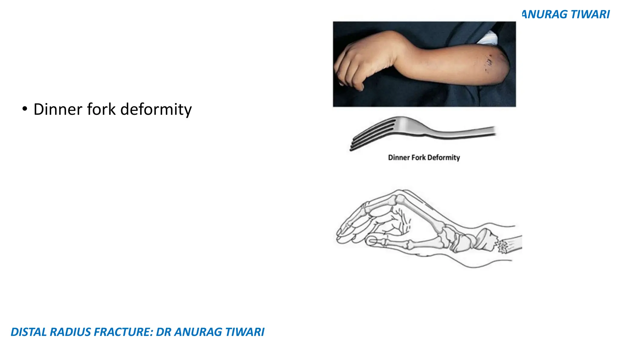 Distal radius #UG .pptx