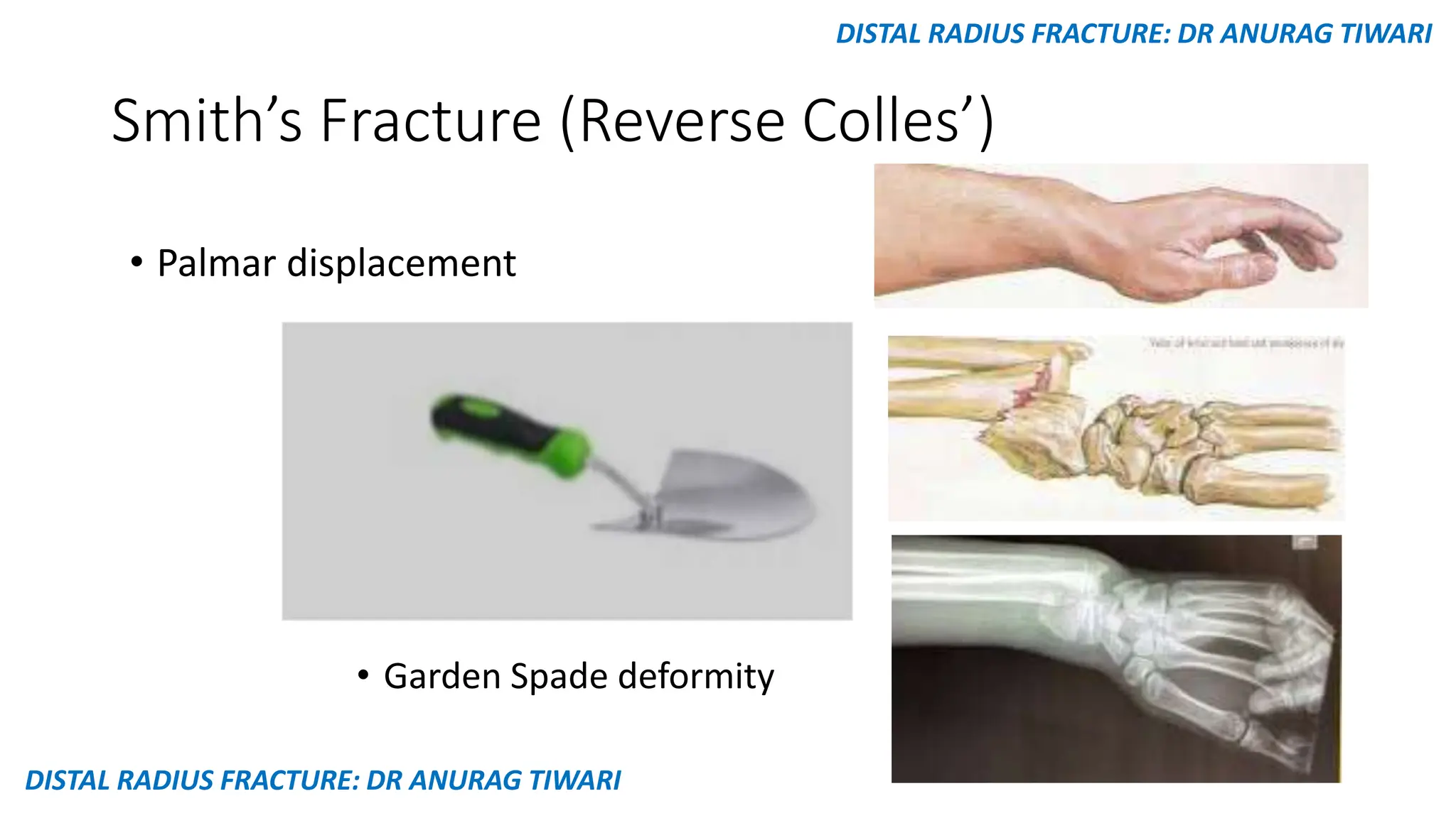 Distal radius #UG .pptx