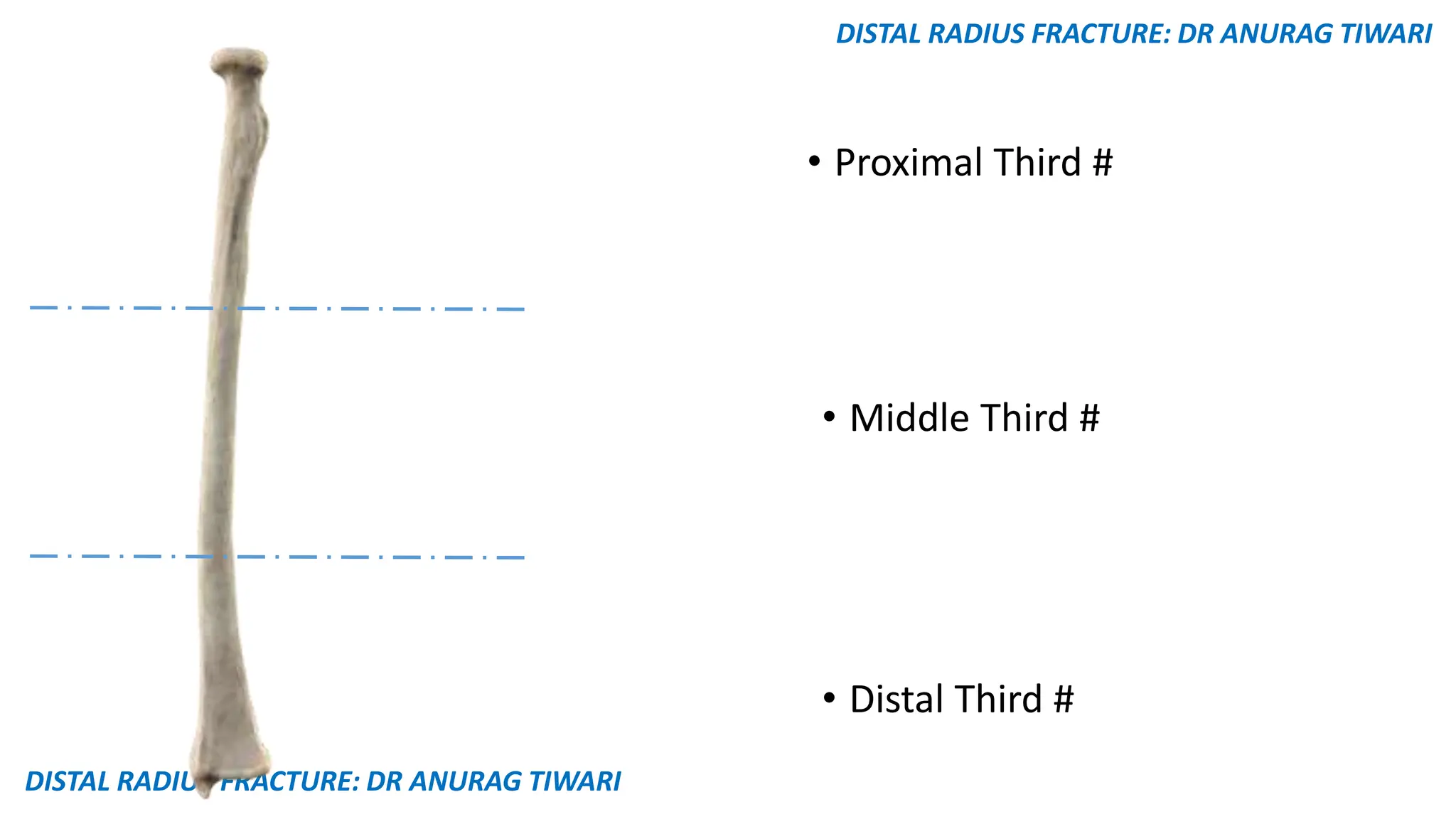 Distal radius #UG .pptx