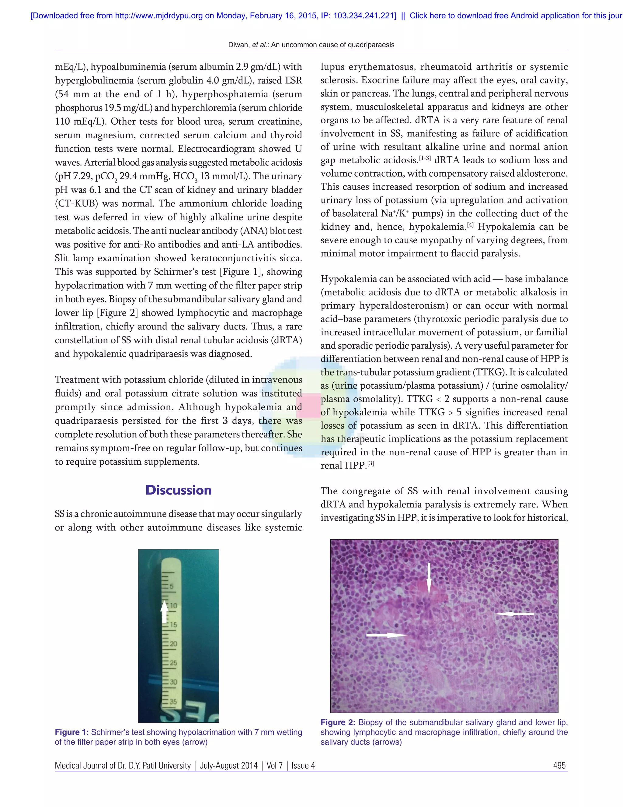Distal renal tubular acidosis and quadriparaesis in sjögren’s syndrome ...