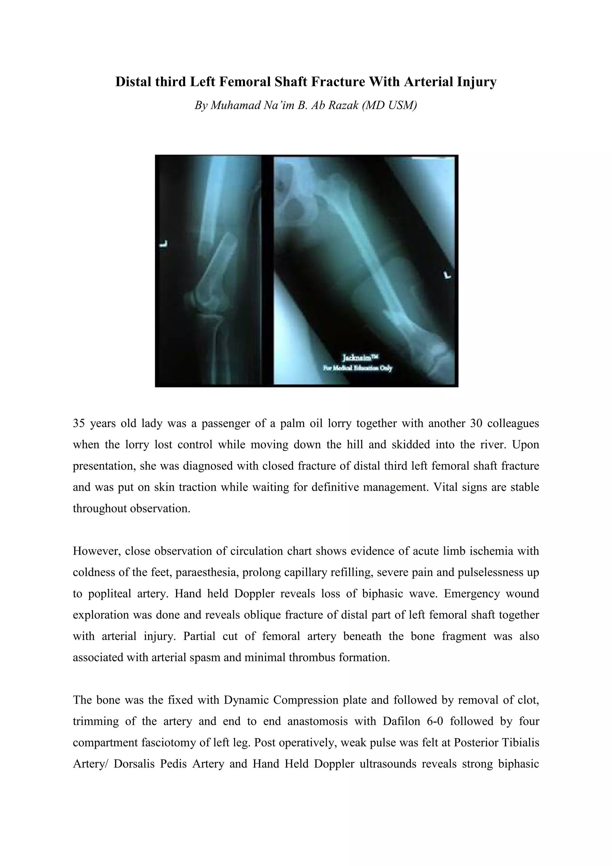 Distal third left femoral shaft fracture with arterial injury | PDF ...