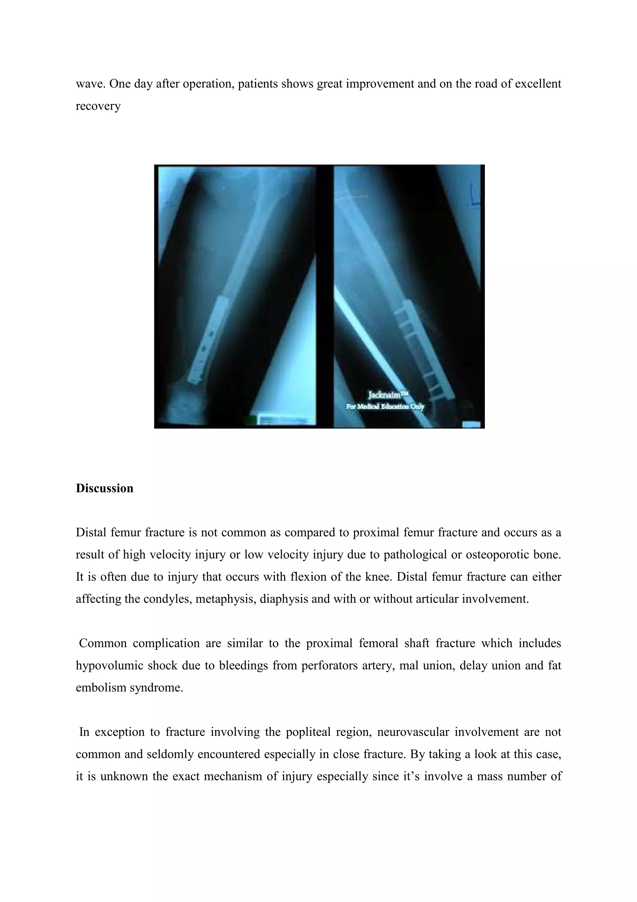Distal third left femoral shaft fracture with arterial injury | PDF ...