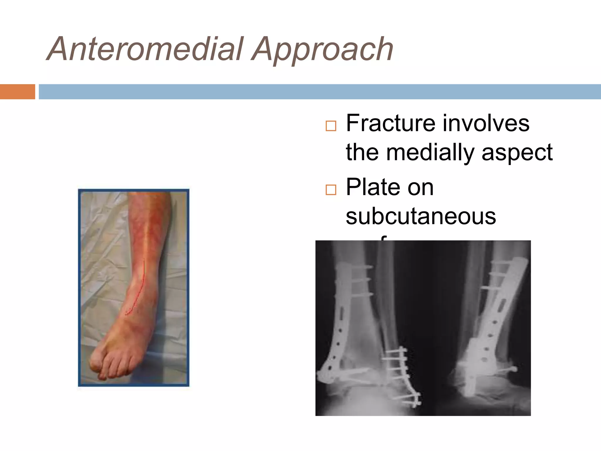 Distal tibia fractures | PPTX