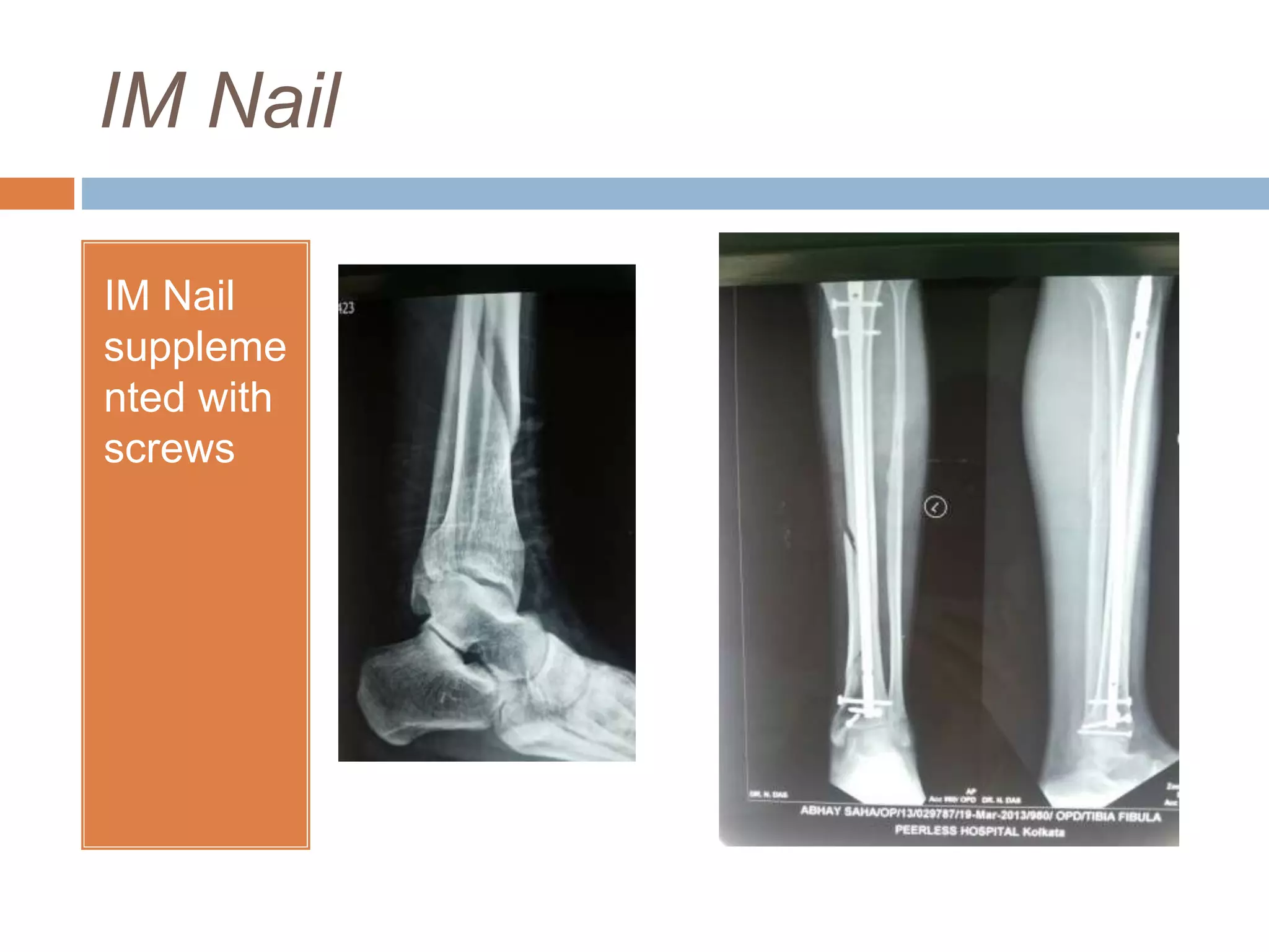 Distal tibia fractures | PPTX