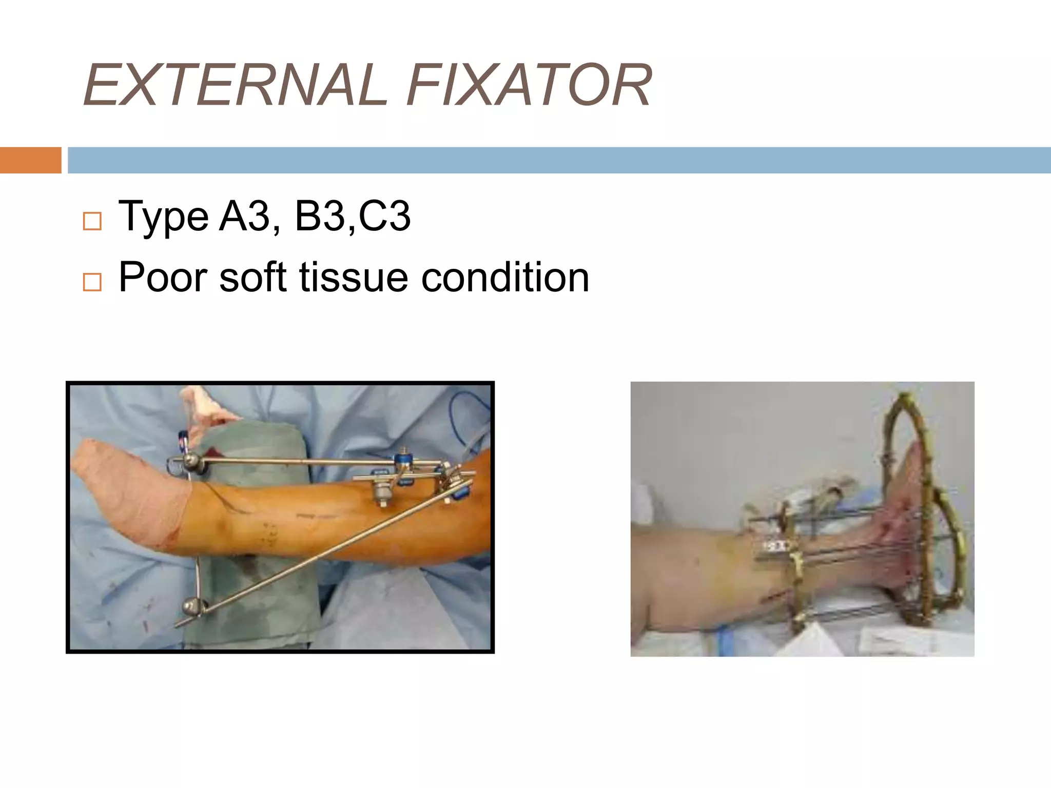 Distal tibia fractures | PPTX