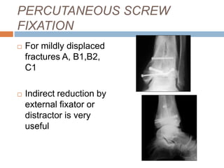 Distal tibia fractures | PPTX