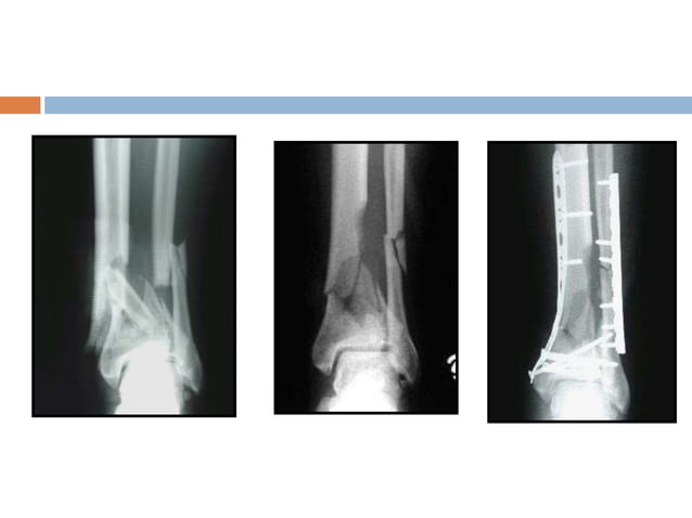 Distal tibia fractures | PPTX | Death, Injury, or Military Conflict | Sensitive Topics