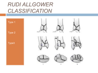 Distal Tibia Fracture Classification