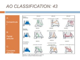Distal Tibia Fracture Classification