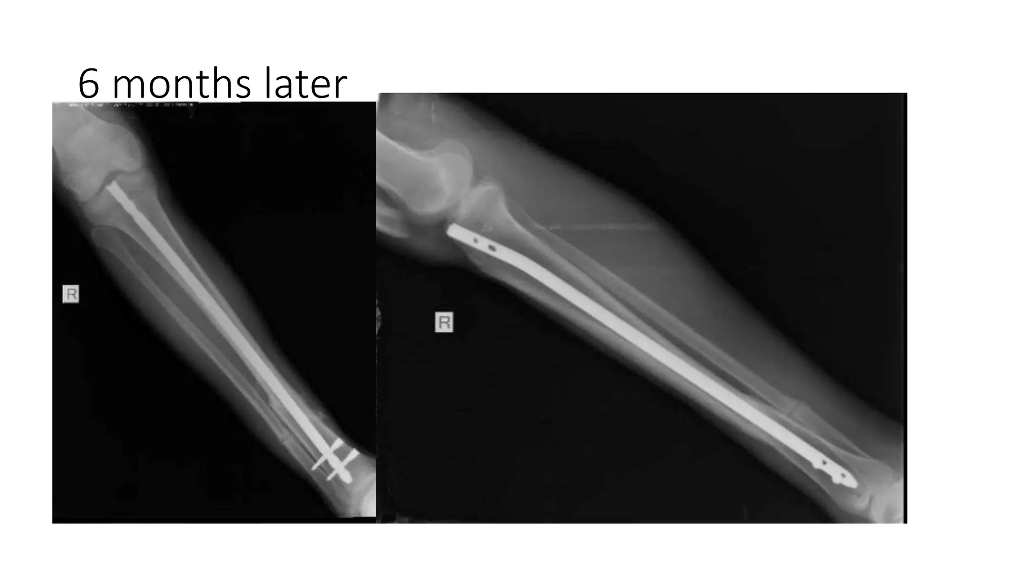 distal tibia malunion orthopedics sem.pptx